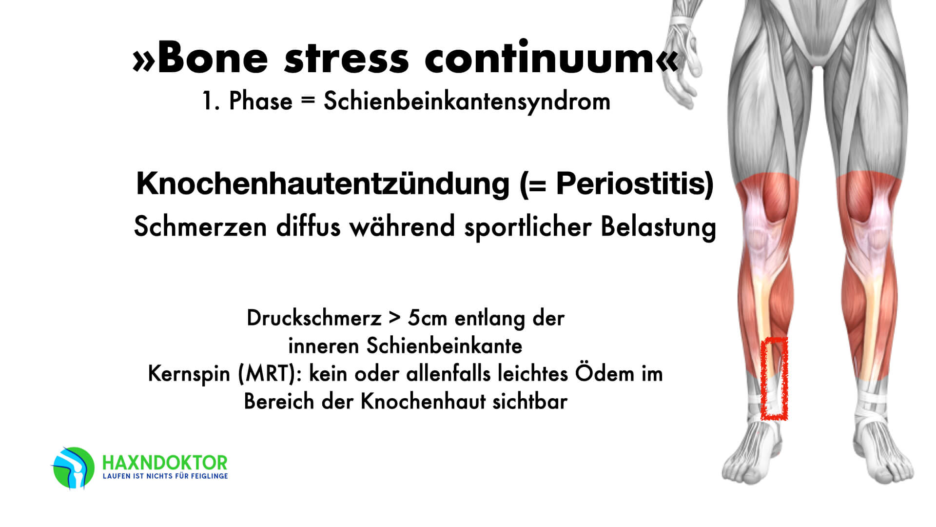 Schienbeinkantensyndrom